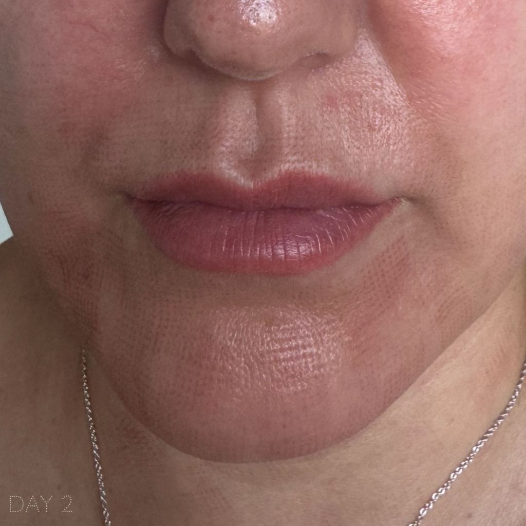 Tixel – Skincare Laser Clinic