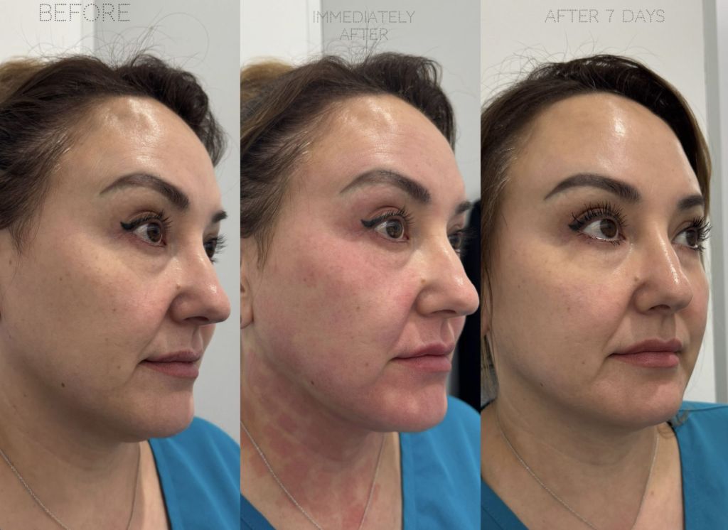 Tixel – Skincare Laser Clinic