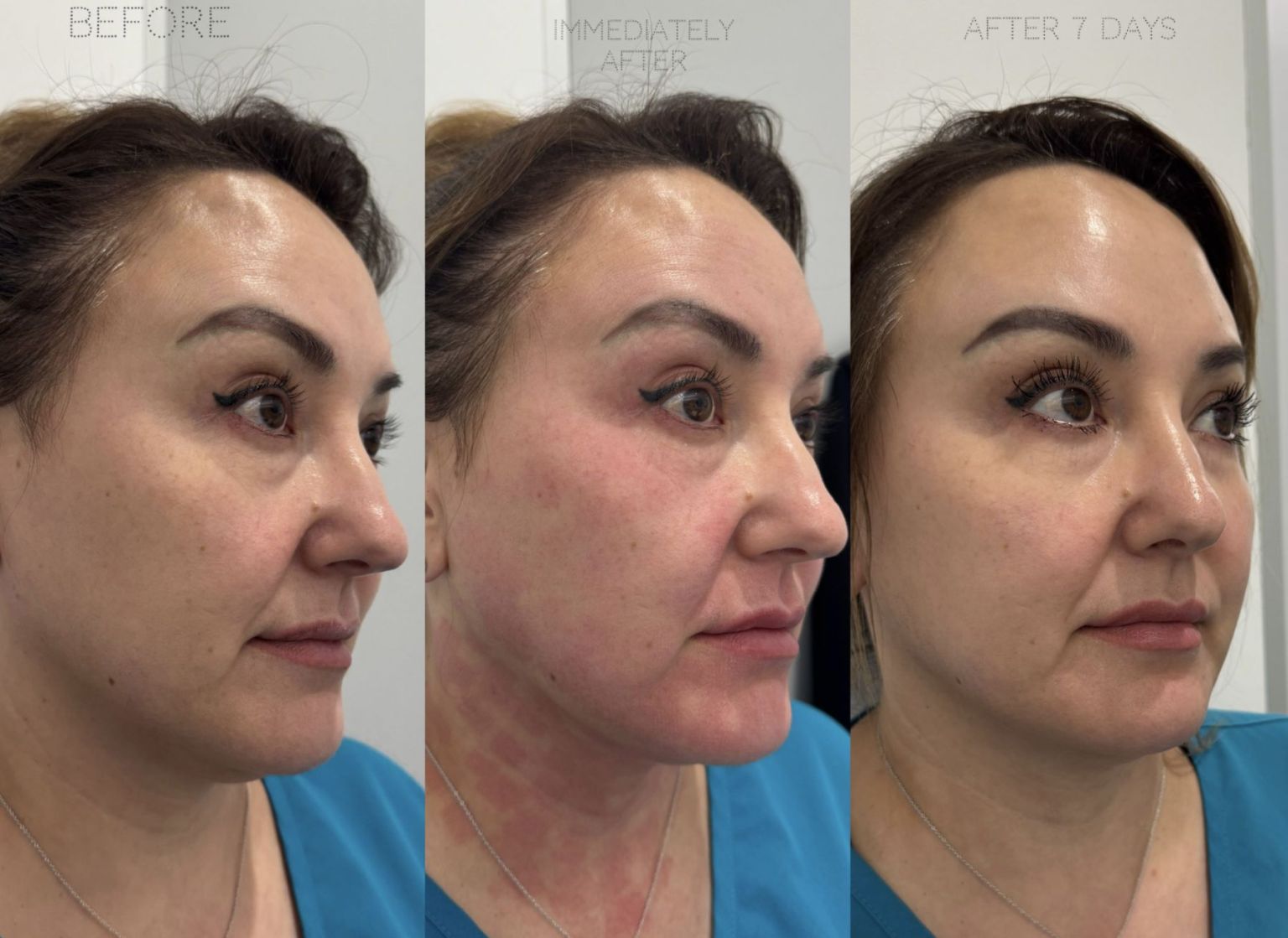 Tixel – Skincare Laser Clinic