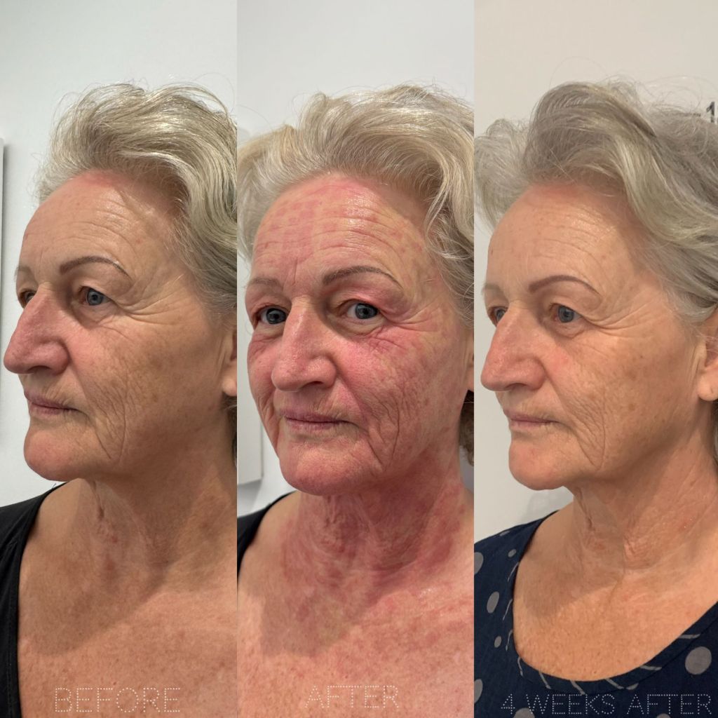 Tixel – Skincare Laser Clinic