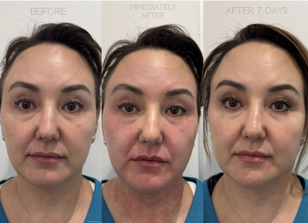 Tixel – Skincare Laser Clinic