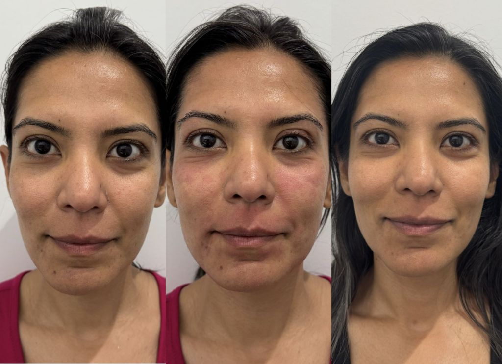 Tixel – Skincare Laser Clinic