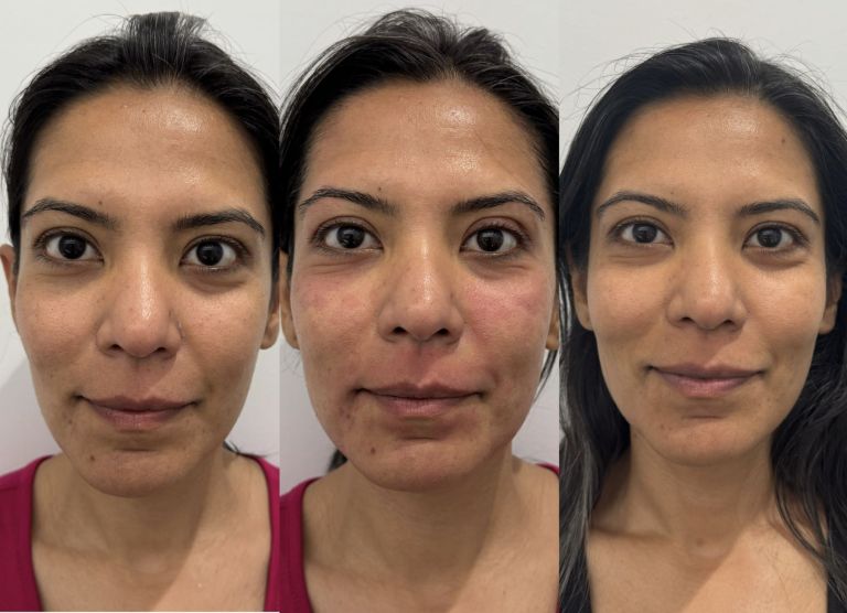 Tixel – Skincare Laser Clinic