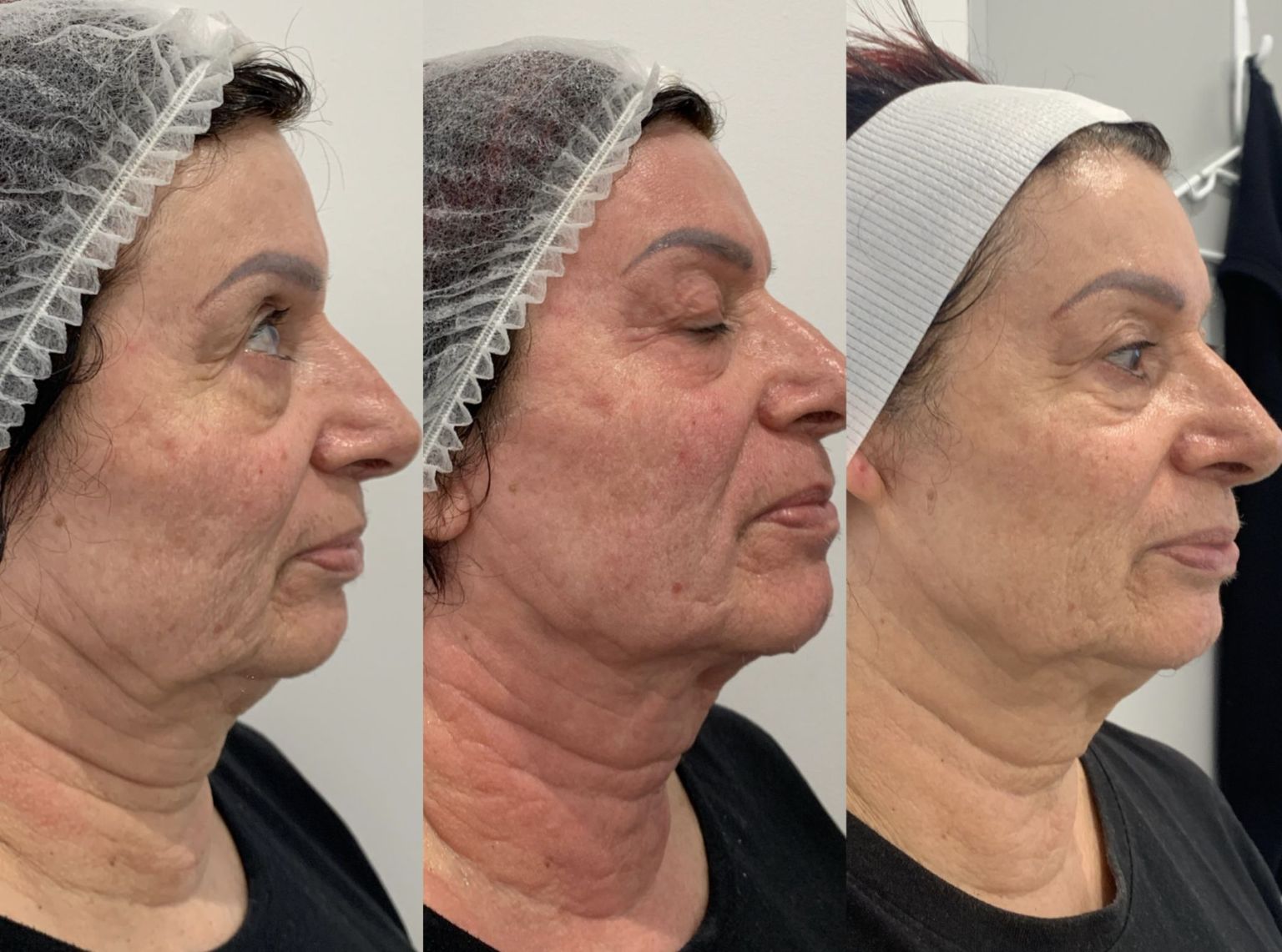 Tixel – Skincare Laser Clinic