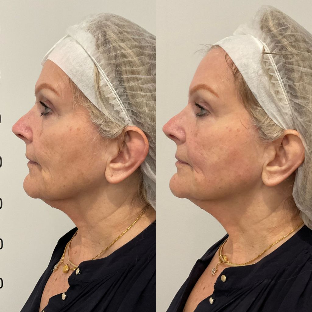HIFU Face Lifting – Skincare Laser Clinic