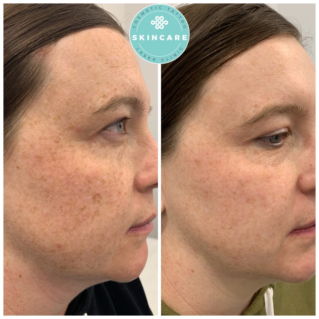 LASER FOR PIGMENTATION – Skincare Laser Clinic