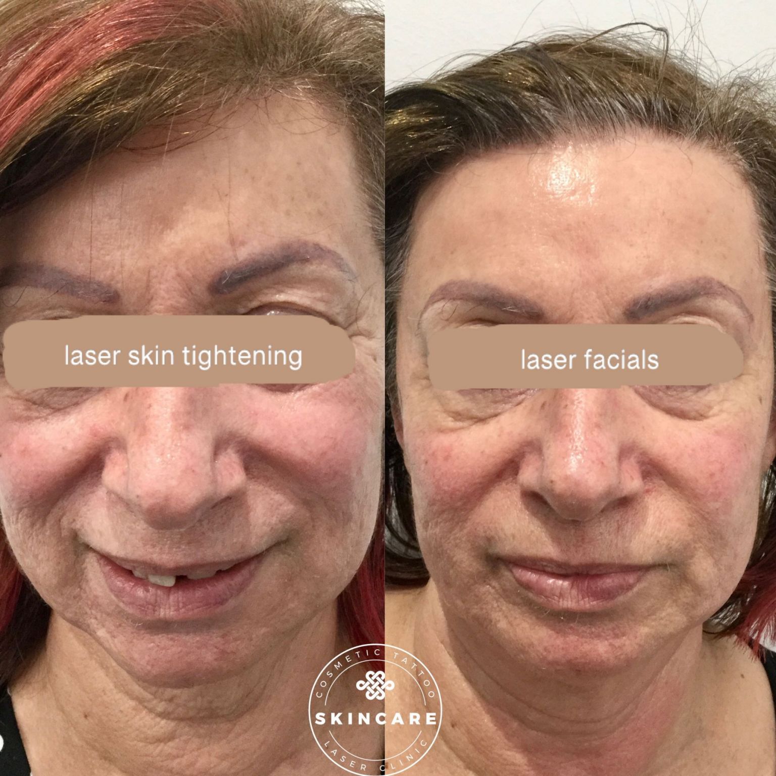 Laser Skin Tightening & Laser For Flushing – Skincare Laser Clinic