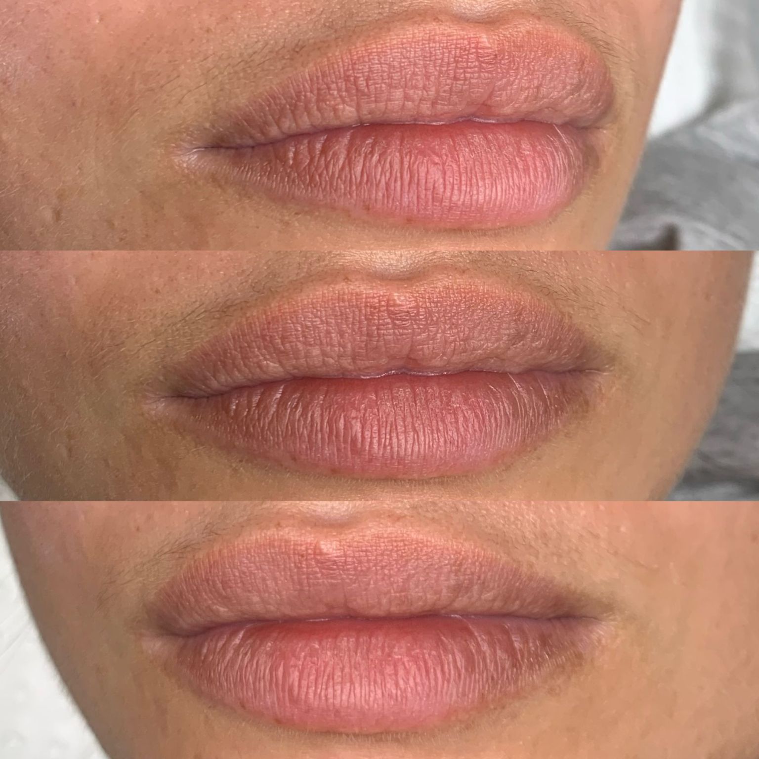 LIP TATTOOING – Skincare Laser Clinic