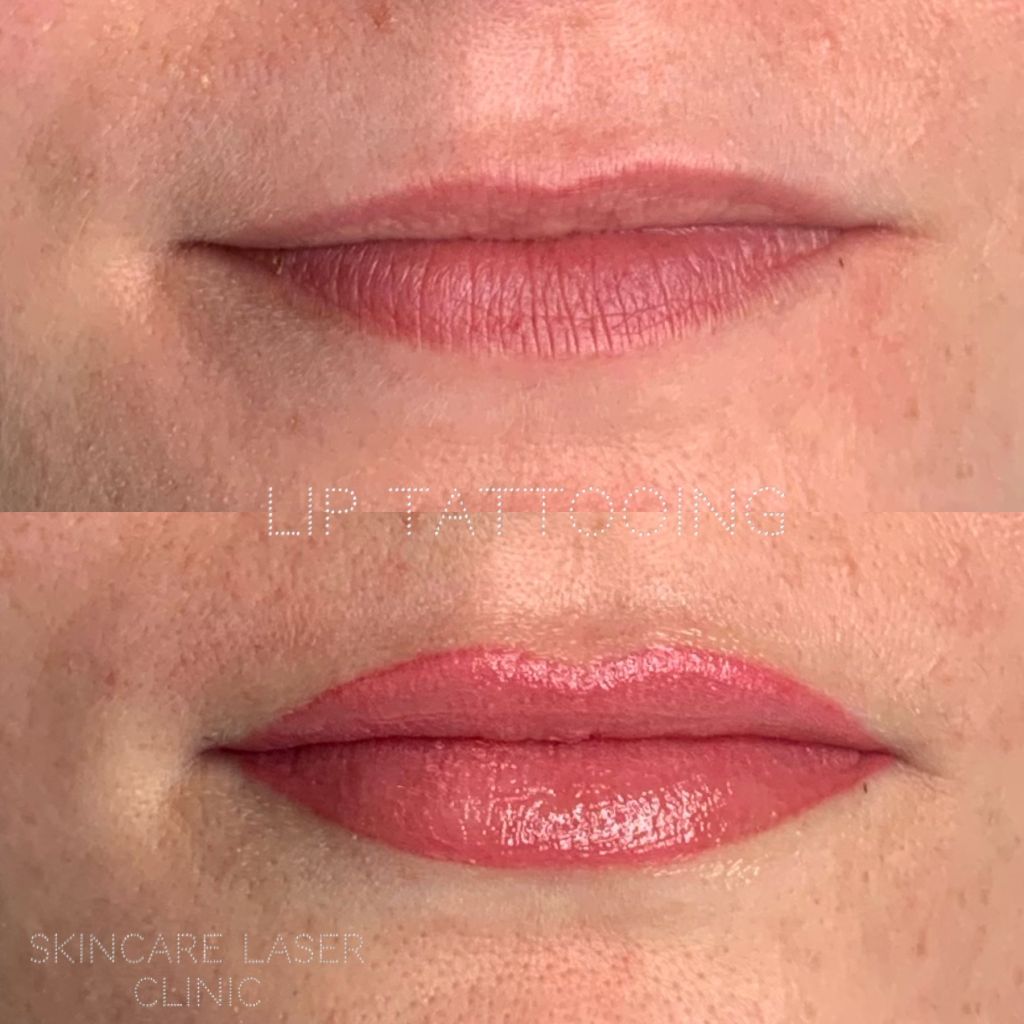 Lip Tattooing / Blushing – Skincare Laser Clinic